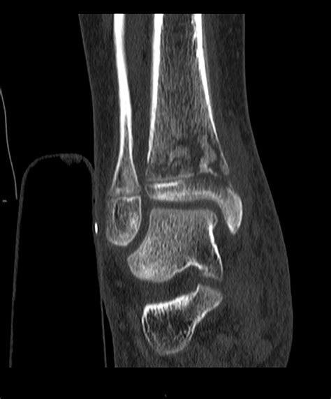 Radiopaedia Case Osteomyelitis With Sequestrum Id 62732 Study 71048