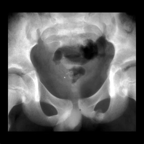 Pediatric Ischiopubic Synchondrosis Asymmetry Pediatric Radiology