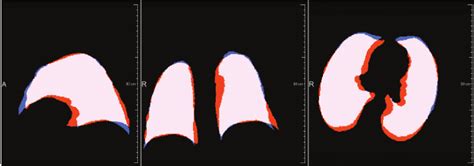 Result Of The Affine Linear Pre Registration Of The Lung Masks In Download Scientific Diagram