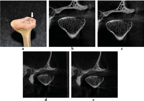 A An Example Photograph Of Condylar Defect Solid White Arrow B
