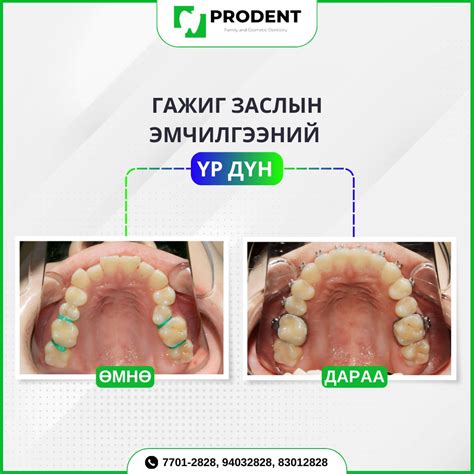 Метал шүдний аппарат уу Шаазан шүдний аппарат уу
