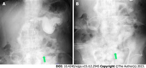 Duodenojejunostomy Bypass Cpt