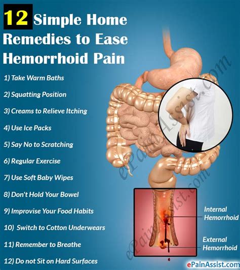 External Hemorrhoids Treatment At Home