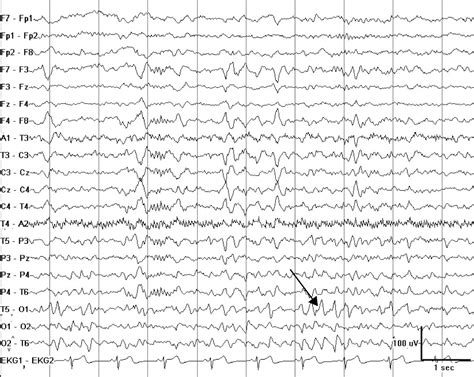 normal eeg