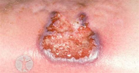 Pyoderma Gangrenosum Image
