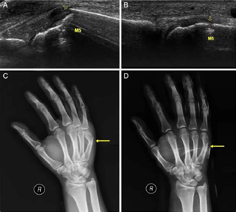 Fifth Metacarpal Neck Fracture Rxharun