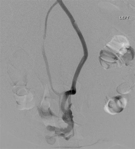 Case 13 Tips With Venous Varices Embolization Ir 4 U