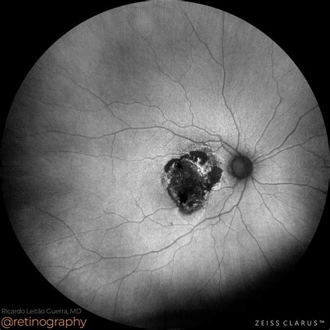 Amd Disciform Scar Retinography