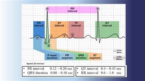 Ecg Vtach Brugada And Vereckei Algorithm Mec Elino Ppt