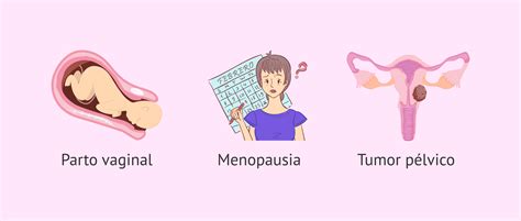 Causas Del Prolapso Uterino