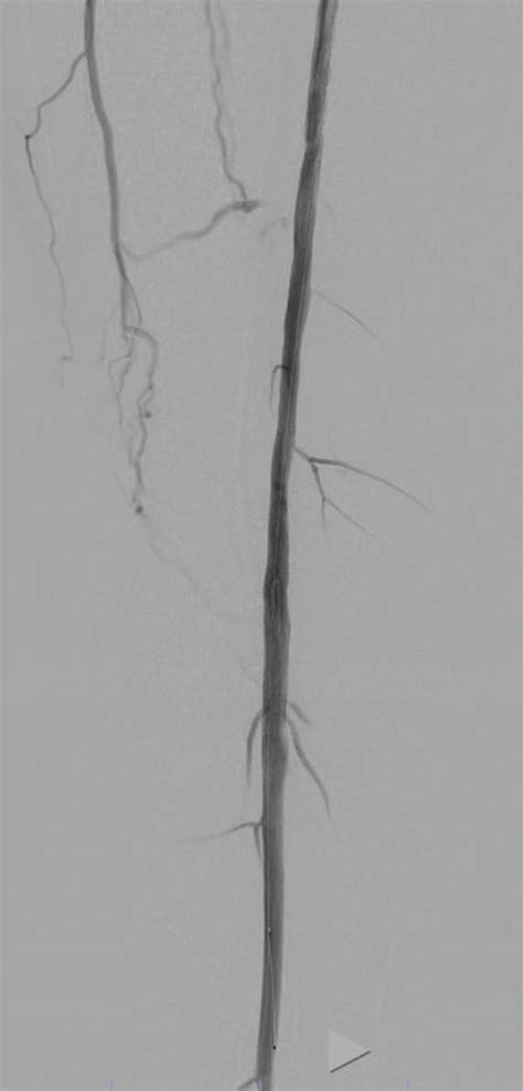 Case Report Long Segment Sfa Stenosis With Cto Treated With Serranator® And Dcb In A Patient
