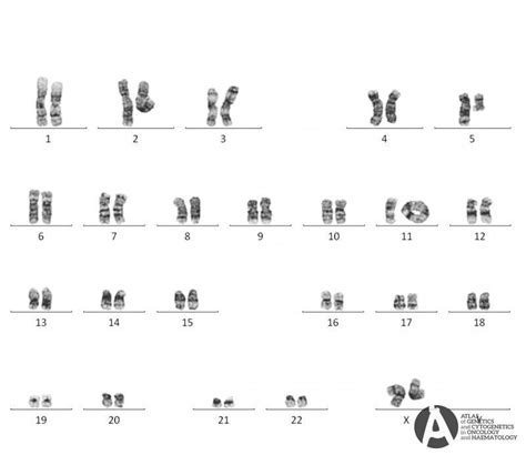 Kmt2a Amplification In Leukemia Detected By Cytogenetics