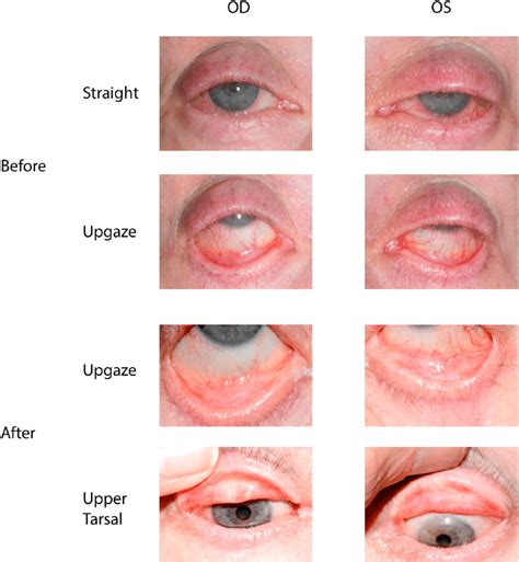 Color Photographs Of Case 1 Before And After Treatment With Tofacitinib