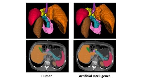 Ai Auto Contouring For Radiotherapy The Friends Of St Lukes