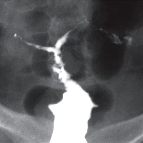 Cervical Tuberculosis Uterine Cavity Has Small Size Diverticular