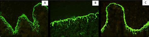 Direct Immunofluorescence Revealed Positive Staining Of Fibrinogen At