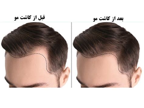 انواع روش های کاشت مو