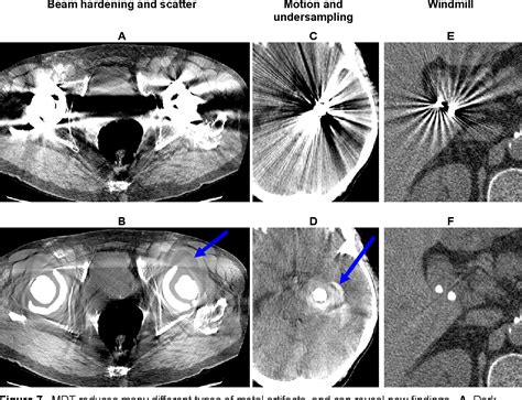 Figure 3 From Ct Artifacts Causes And Reduction Techniques Semantic