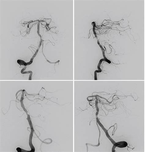Basilar Artery Occlusion Clinical Management And Therapy