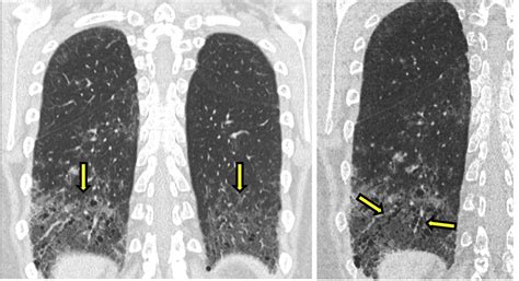 Systemic Sclerosis And Interstitial Lung Disease From Pathogenesis To