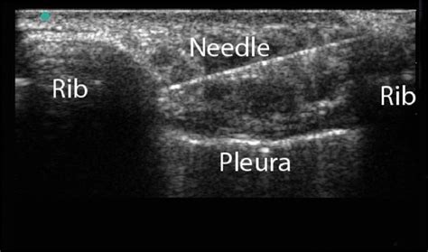 Intercostal Nerve Block Anesthesia Key