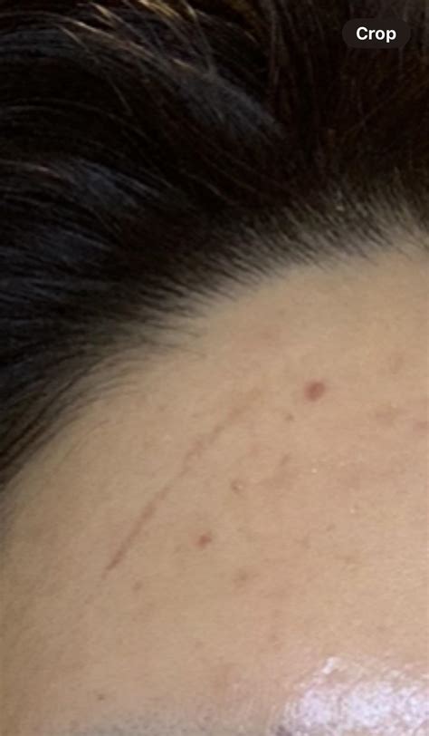 What Is This Red Line It Appeared After Putting My Face In Massage Bed For Hour R