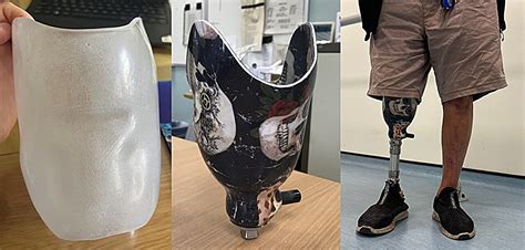 Data Driven Prosthetics Faster Personalized Leg Design Archyde