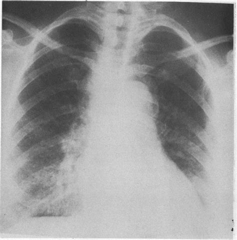 Chest Radiograph At Presentation Showing Interstitial Infiltrate In The Download Scientific