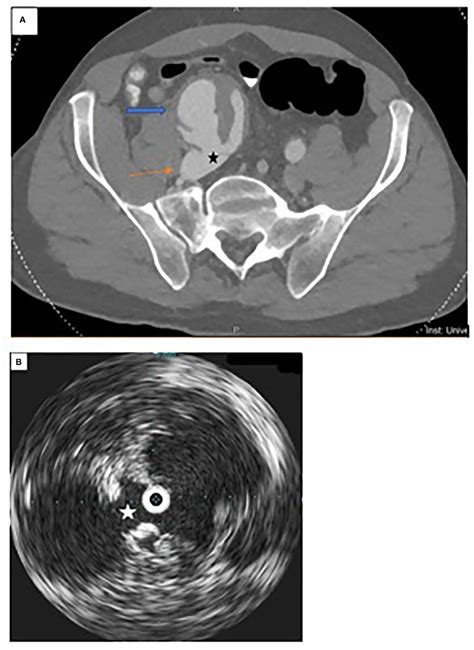 Additional Imaging Of Fistula A Ct Angiogram Demonstrating