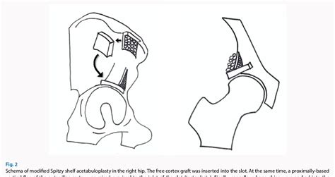 Figure 1 From The Modified Spitzy Shelf Acetabuloplasty For The