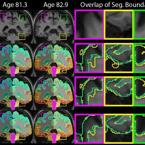 Qualitative Results Of Deploying Longitudinal Segmentation Methods On Download Scientific