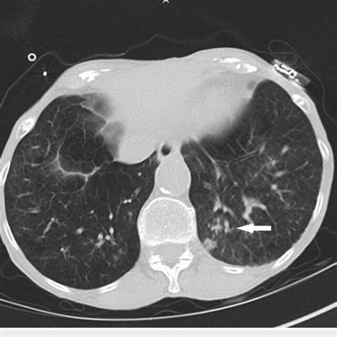Computed Tomography Of The Chest Showed Tree Inbud Opacities Along With Download Scientific