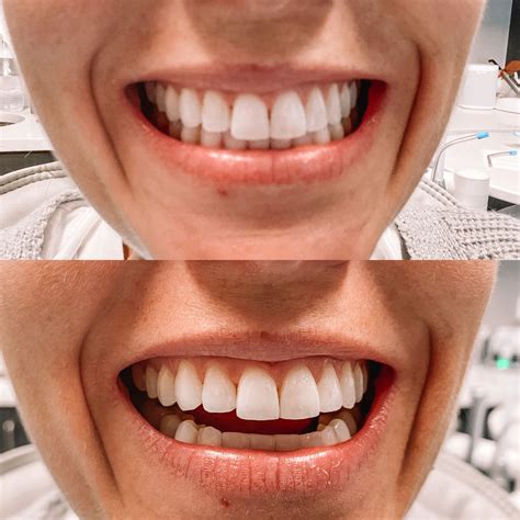 Tooth Whitening After Invisalign At Nadine Boeding Blog