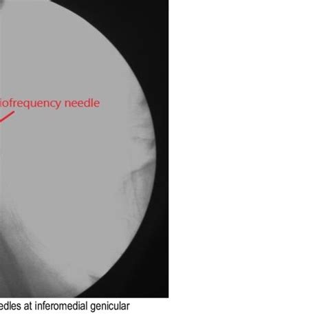 ] Ap View Radiofrequency Needles At Inferomedial Genicular Nerve Download Scientific Diagram