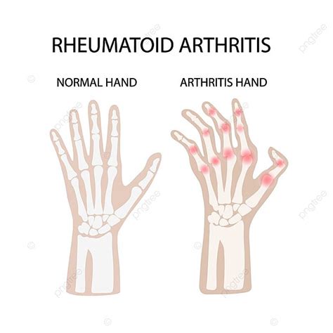 Rheumatoid Arthritis System Disorder Template