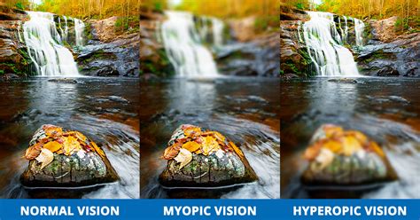 Hyperopia Causes Symptoms Treatments Apec