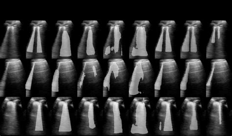 Three Example Lus Images Each Illustrating Segmentations From Each Of Download Scientific