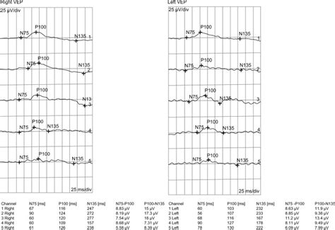 Visual Evoked Potentials Revealed Delayed P100 Latencies Particularly Download Scientific