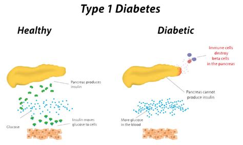 Type 1 Diabetes Mellitus Renae Hay Exercise Physiologist