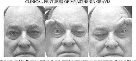 Figure 72 From Clinical Features Of Myasthenia Gravis Semantic Scholar