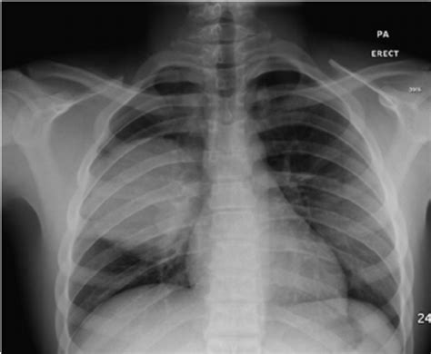 Right Middle Lobe Opacity Download Scientific Diagram