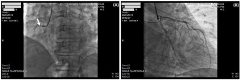 The Conundrum Of Cancer Associated Thrombosis Lesson Learned From Two Intriguing Cases And