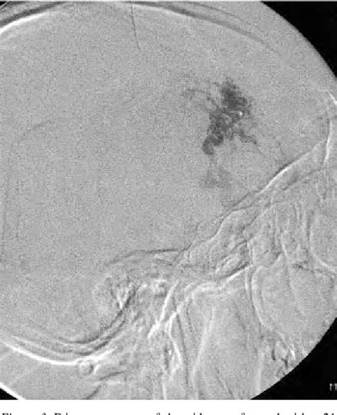 Figure 1 From Treatment Of A Scalp Arteriovenous Malformation By A Combination Of Embolization