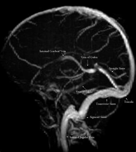 Normal Anatomy Of The Venous Circulation As Seen On Lateral Projection