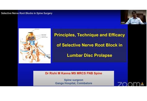 Selective Nerve Root Blocks In Spine Surgery —