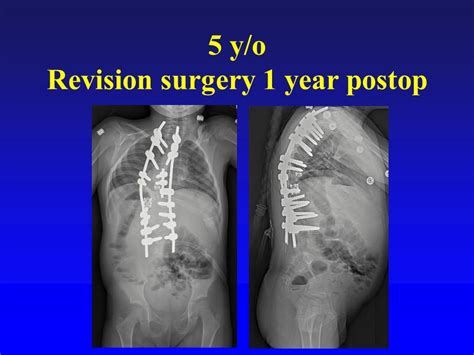 Blog Topic Severe Complex Congenital Scoliosis Cases Using Spinal