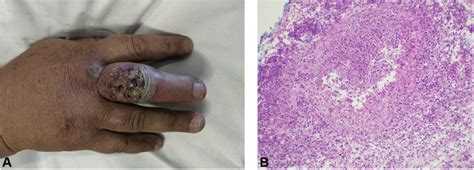 Cutaneous Polyarteritis Nodosa With Clinical Features Of Pyoderma