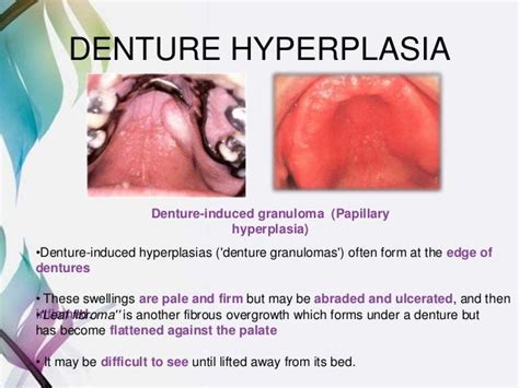 Oral Mucosal Lesions In Denture Wearers
