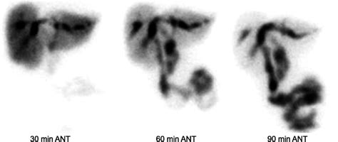 Postoperative Hepatobiliary Scintigraphy Of Case 2 Showing Uneventful