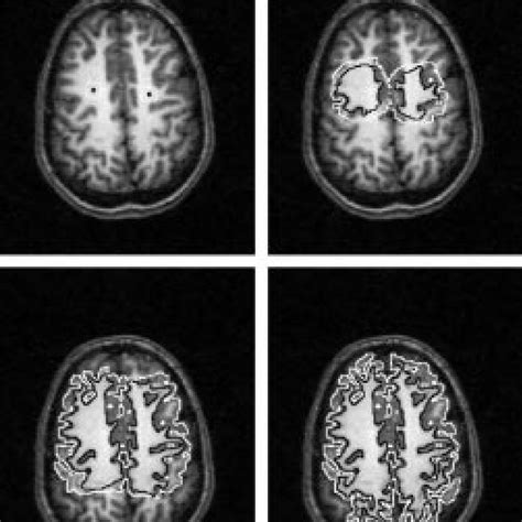 Gray Matter Segmentation In A Mri Brain Image The White Contour